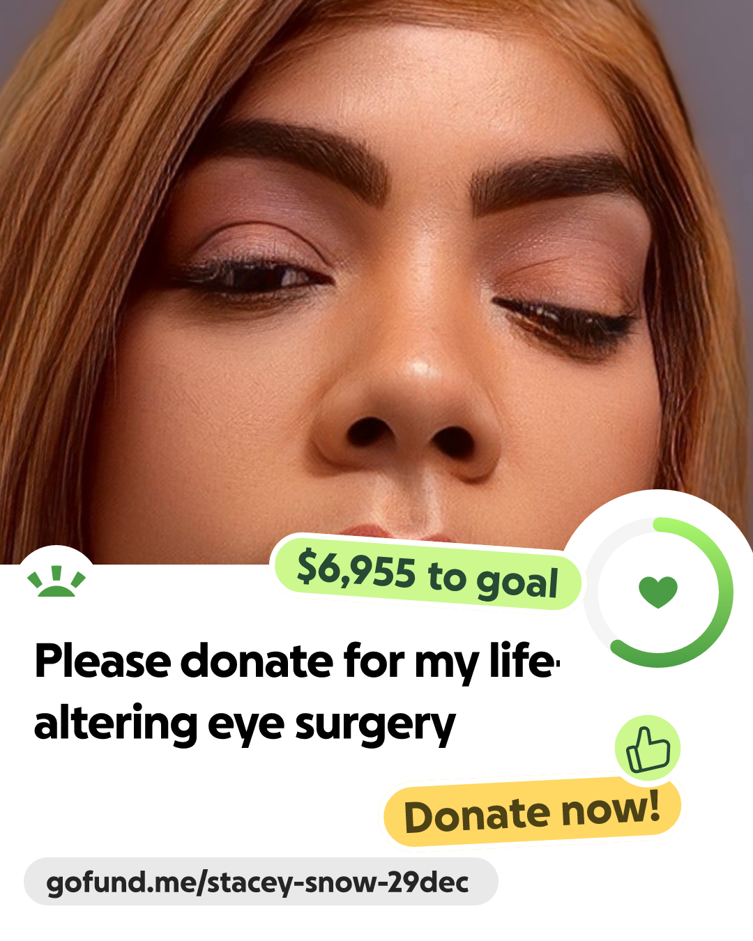 Fundraiser by Stacey Isaacs : Please donate for my life-altering eye ...